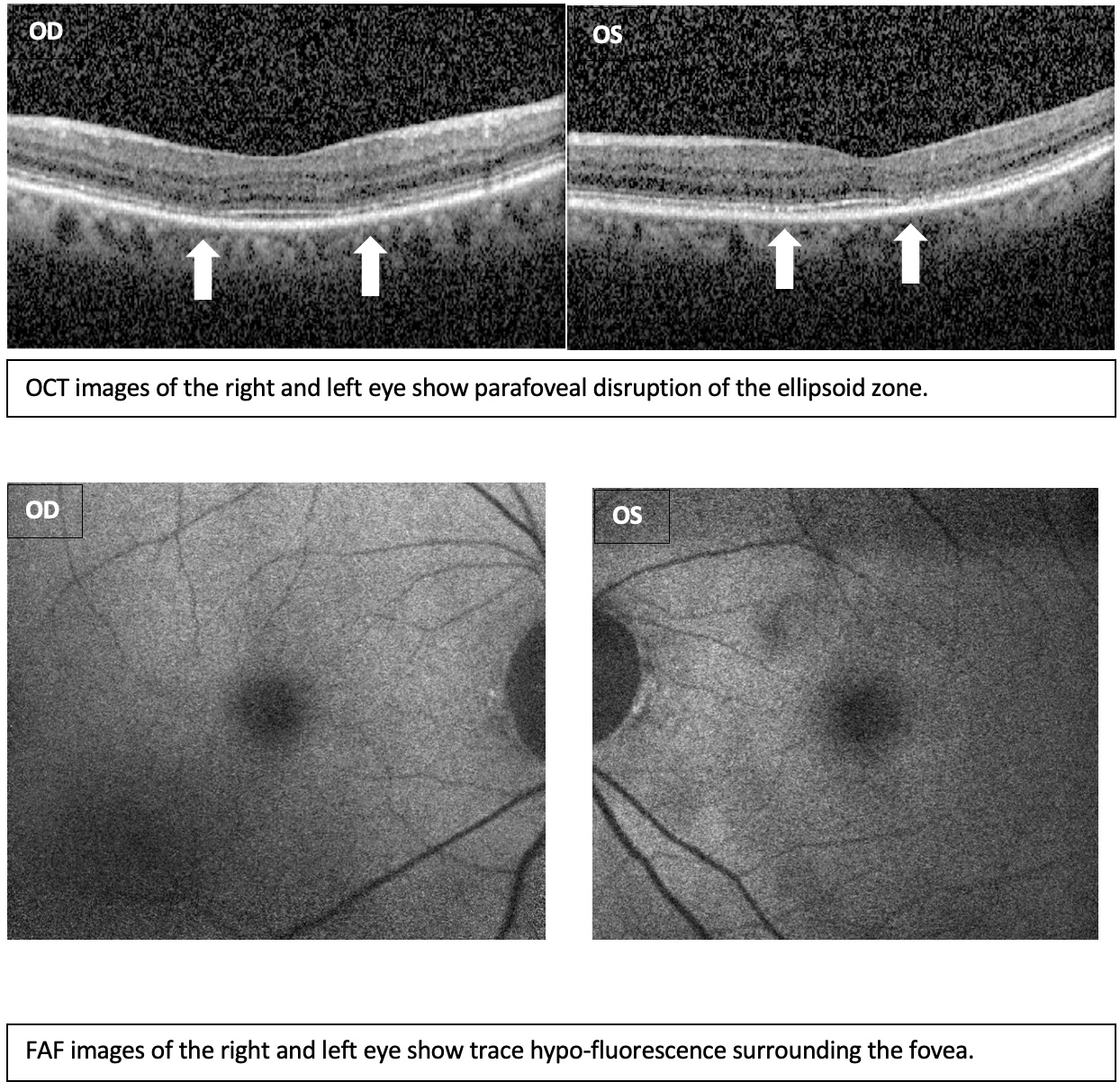 Asymptomatic And Early Hydroxychloroquine Retinal Toxicity Colorado Asymptomatic And Early Hydroxychloroquine Retinal Toxicity Colorado